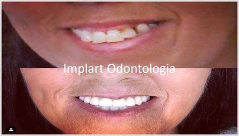 Reabilitacao oral implantes dentarios 40kb 1 Clínica Odontológica