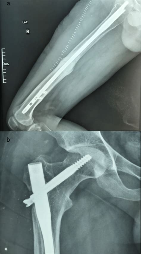 Radiographic Imaging Of The Right Femur Showing A Well Positioned Gamma