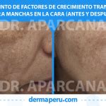 Factores de crecimiento tranexámico para manchas en la cara Antes y