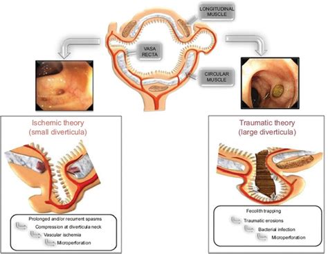 Diverticular Disease Causes Symptoms Diagnosis Treatment