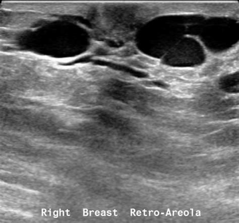 Breast Pathology Flashcards Quizlet