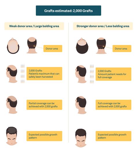 Top 114 Does Health Insurance Cover Hair Transplant