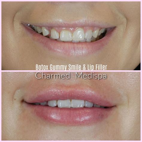 Can Botox Fix Asymmetrical Lips Lipstutorial Org