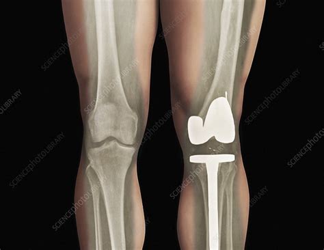 Total Knee Replacement X Ray Stock Image C015 4953 Science Photo