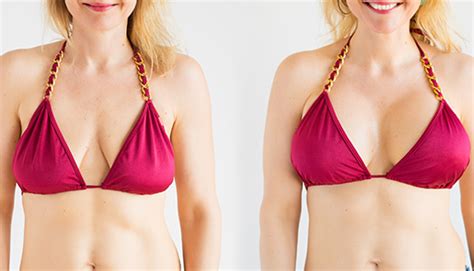 Breast Augmentation Surgery In Cleveland Oh Greer Plastic Surgery