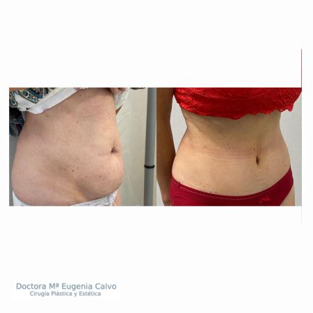atmósfera paso libertad abdominoplastia fotos reales En particular
