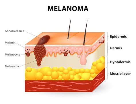 Sun Damage And Cancer How Uv Radiation Affects Our Skin