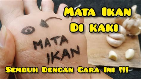 Mata Ikan Di Kaki Sembuh Dengan Cara Ini Sederhana Tapi Ampuh Dan