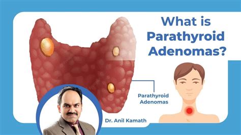 What Is Parathyroid Adenomas Symptoms And Treatment Dr Anil Kamath