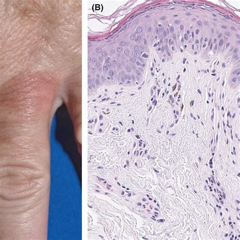 A Ovoid Erythematous Smooth Patch On Left 4th Digit Developing Within