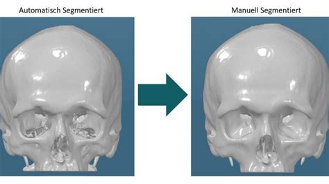Modulare Trainingsmodelle In Der Neurochirurgie Kraniotomie