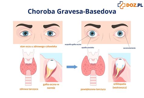 Choroba Gravesa Basedova Objawy Rozpoznanie Leczenie