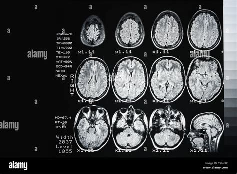Le R Sultat Est Une Irm Du Cerveau Avec Des Valeurs Et Des Chiffres