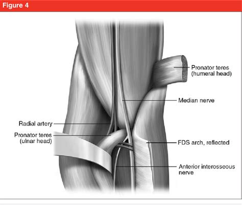 Figure From Pronator Syndrome And Anterior Interosseous Nerve