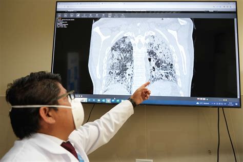 EsSalud realizó exitoso primer trasplante bipulmonar a paciente adulto