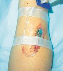 IV Therapy Flashcards Quizlet
