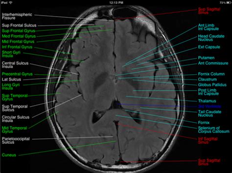Radiology Anatomy Images Brain Mri Anatomy
