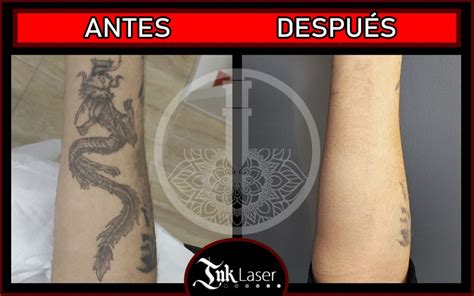 Cómo queda la piel antes y después de borrar un tatuaje