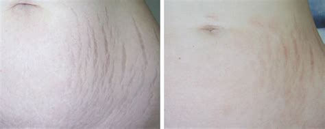 Stretch Mark Removal London Surrey Premier Laser Clinic
