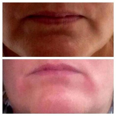 Marionette Lines Botox Before And After Pictures 2 Facial