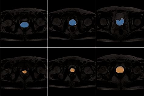 three dimensional convolutional neural network for prostate mri segmentation and comparison of