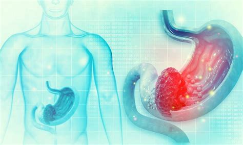 Alimentos Recomendados Para Aliviar La Gastritis Es Nutrici N