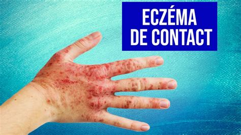 Ecz Ma De Contact Explications Et Traitements Youtube