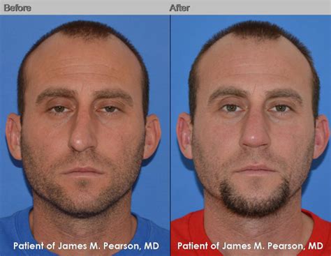 Deviated Septum Surgery Before And After