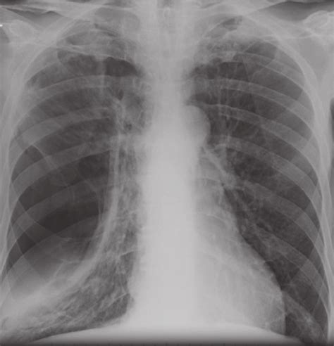 X Ray Chest Postero Anterior View Showing Loculated Pneumothorax