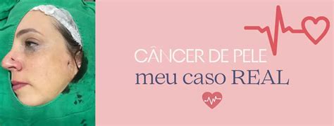 CÂNCER DE PELE INÍCIO MEU CASO REAL Muito Diva