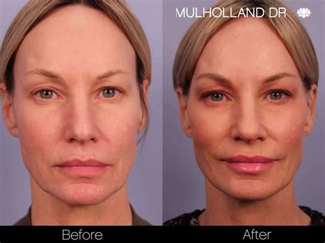 Morpheus8 Before And After Photos Results Face Neck More