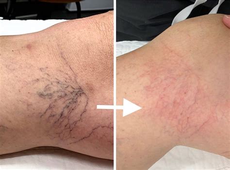 How Many Laser Treatments For Spider Veins The BEAUTIOUS