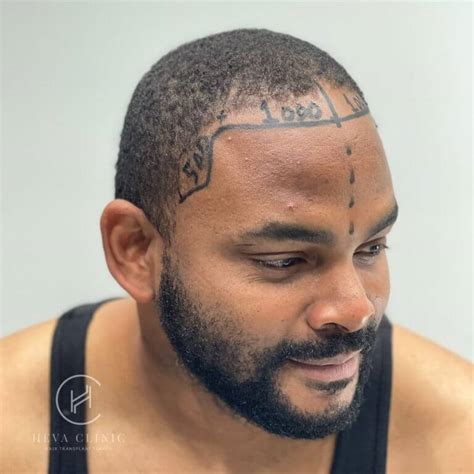 Greffe De Cheveux Afro En Turquie Proc Dure Et Co T En Heva