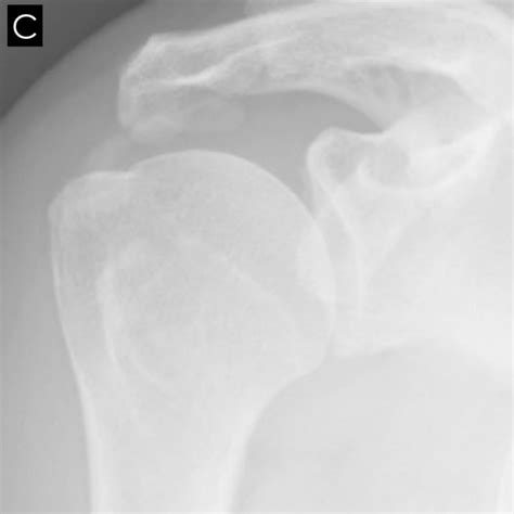 Arthroscopic Removal Of Rotator Cuff Calcium Deposits Doctor Matthieu