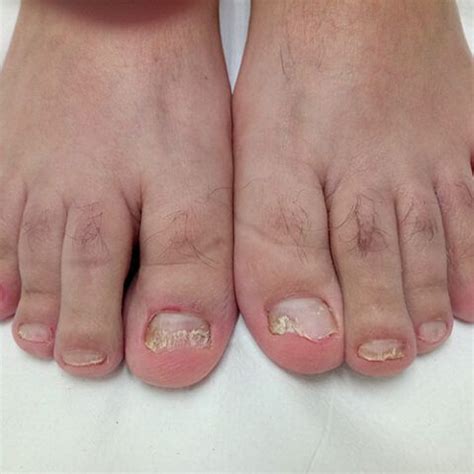 Onicomicosis Hongos en las uñas Clínica Tufet Tufet Salud
