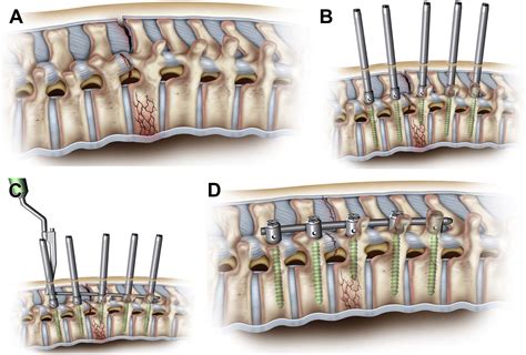 Percutaneous Pedicle Screw Fixation For Thoracolumbar Fractures