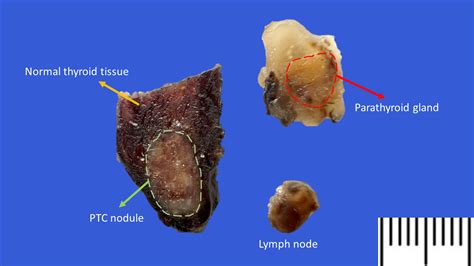 Pathology Outlines Anatomy Histology Parathyroid
