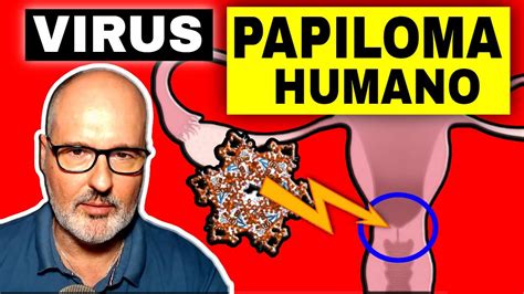 Síntomas del VPH VIRUS del PAPILOMA HUMANO Cáncer Vacuna