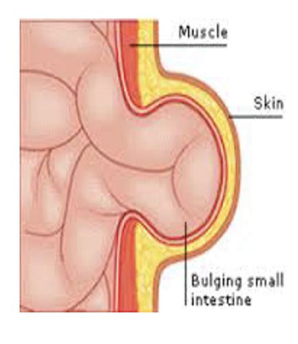 Hernia And Groin Swelling Flashcards Quizlet
