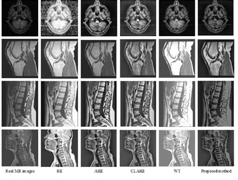 figure 3 from mr image enhancement using stationary wavelet transform based approach semantic