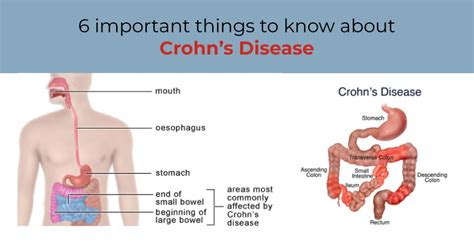 Six Important Things To Know About Crohn S Disease