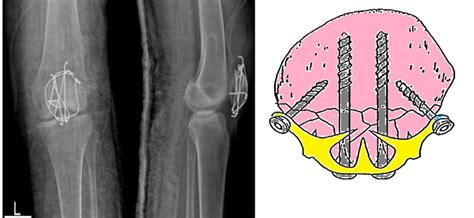 Imágenes De Fracturas Conminutas