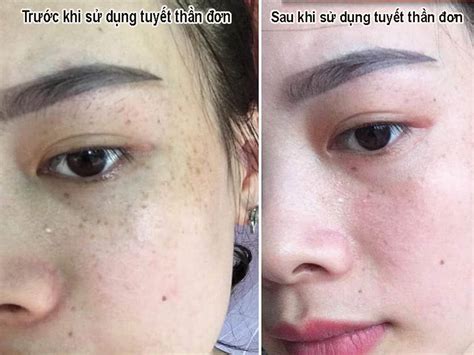 Top 22 Kem Trị Mụn Và Tàn Nhang Hiệu Quả Tốt Nhất Hiện Nay Top 22 Kem