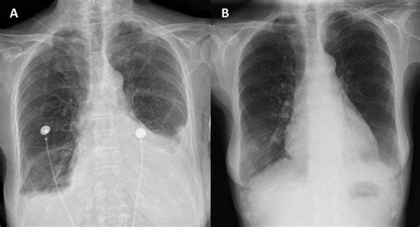 5 Radiografia Torax Derrame Pleural Izquierdo Ocronos Editorial