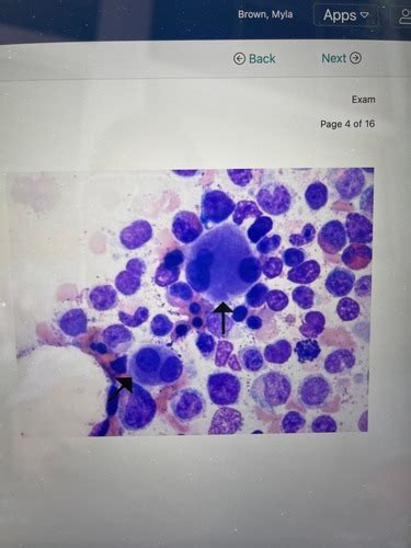 Media Lab Myelodysplastic Syndromes Flashcards Quizlet