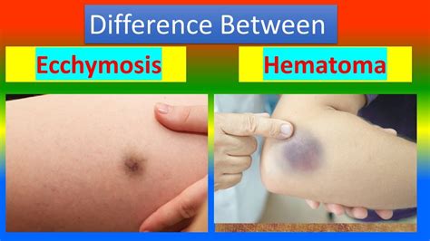 Difference Between Ecchymosis And Hematoma Youtube