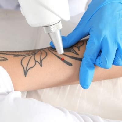 Eliminación de Tatuajes Unidad Dermatológica Dra Emma Guzmán