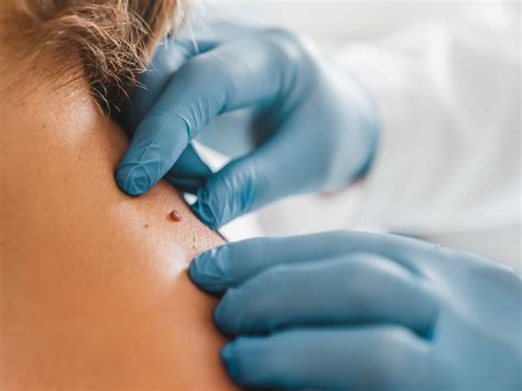 How To Remove Skin Tags The Right Way According To Dermatologists Self