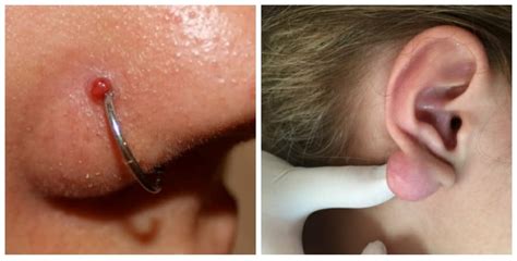 Queloide ou granuloma Entenda a diferença Blog Tattoo2me