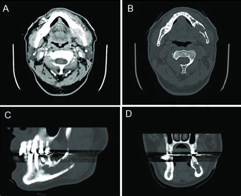 A Contrast Enhanced Axial Computed Tomography CT Images Showing The